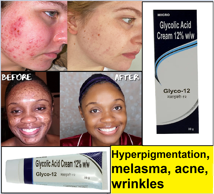 GLYCO 12 Glycolic Acid CREAM 12 Reduces Wrinkles Prevents Acne 30 gm eBay