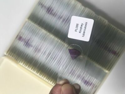 100pcs Medical Human Pathology Slides Set Pathological Disease Prepared ...