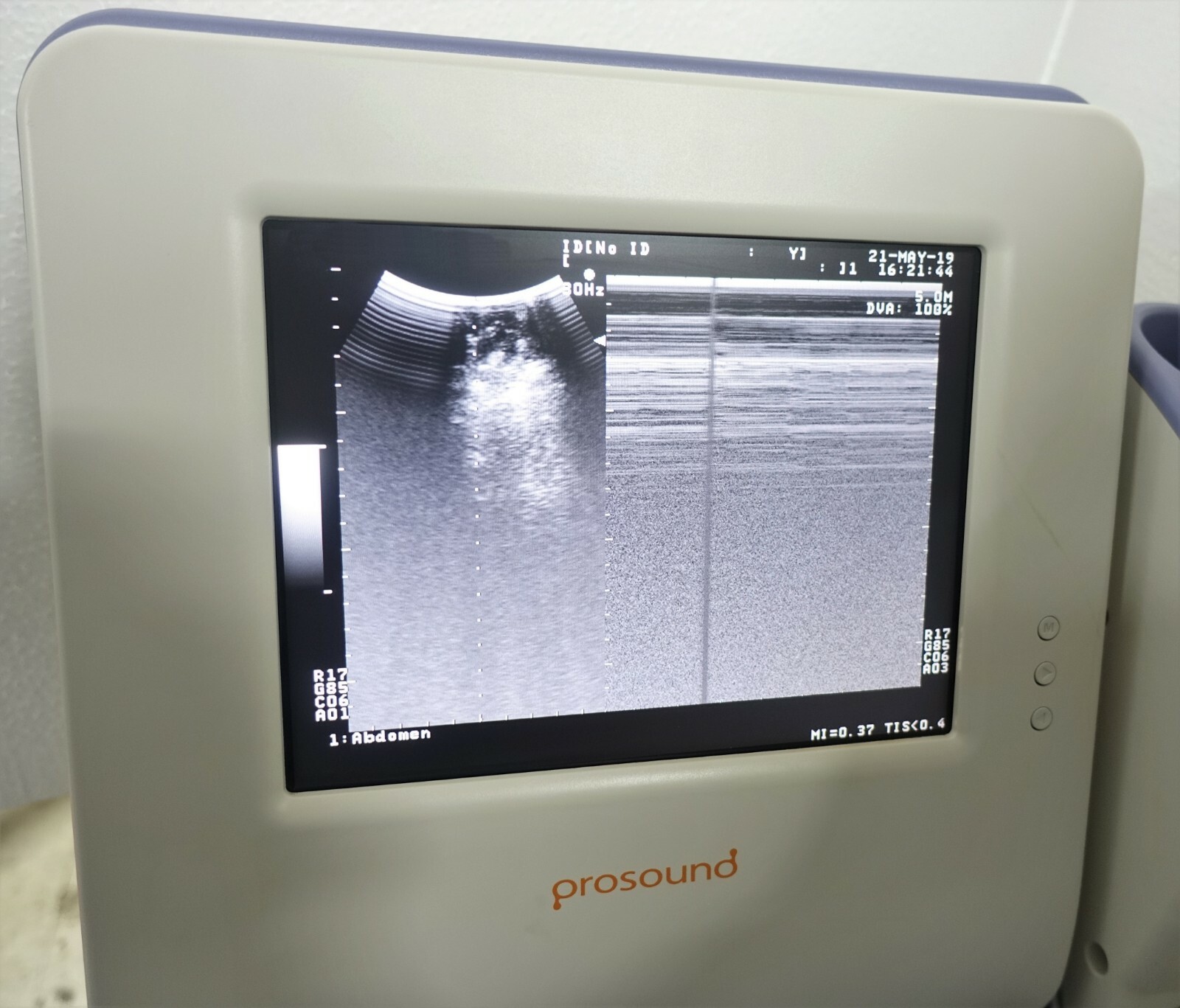 HITACHI ALOKA PROSOUND 2 DIAGNOSTIC ULTRASOUND P2 PORTABLE w UST-934N-3 ...