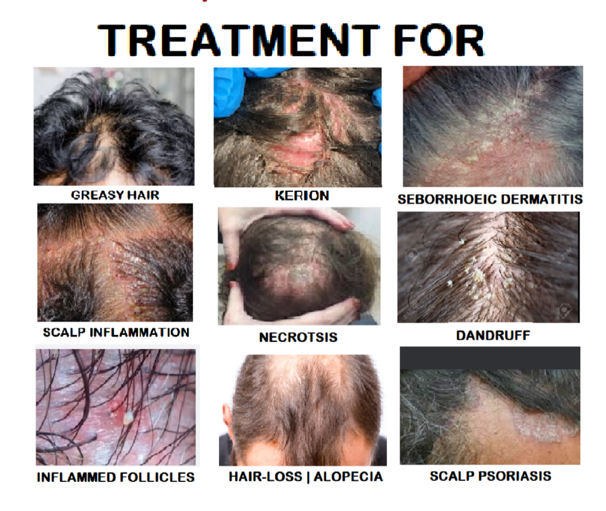 Impetigo Scalp Impetigo Dermatology Advisor