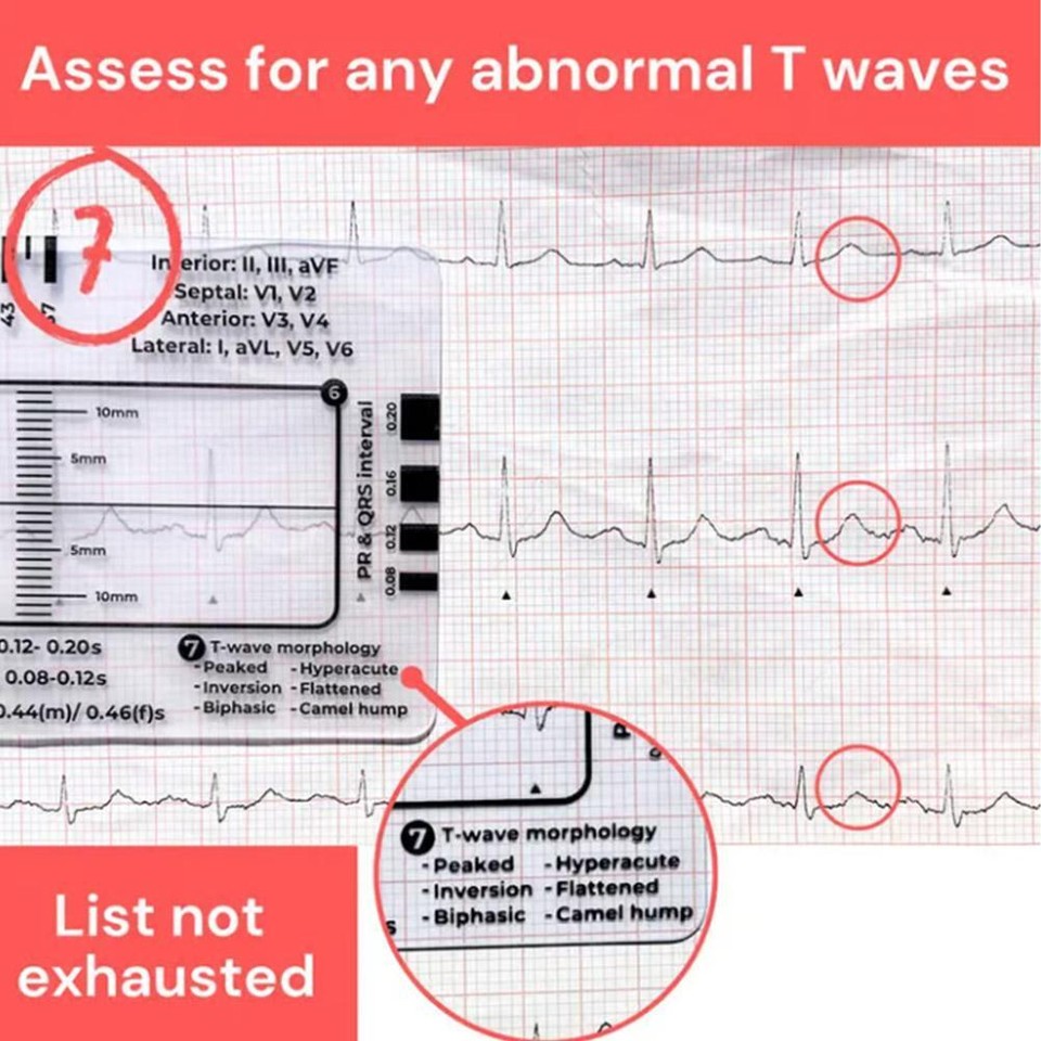 ECG Analysis & Interpretation (EKG) Medical EKG Cardiometer Ruler ...
