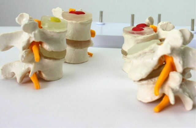 PVC Anatomical Human Lumbar Vertebrae Degenerative Disc Disease Model 2 ...