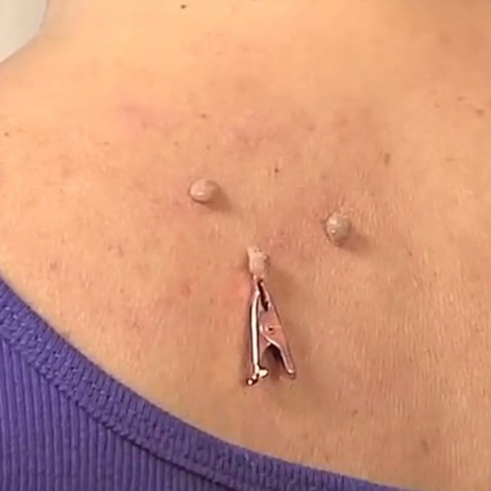 1 Box/12Pcs Copper Skin Tag Remover Clips Wart Tag Extractor Copper Tag ...