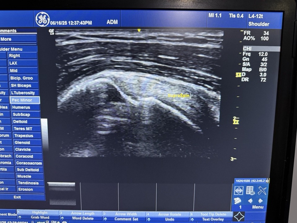 GE Logiq e R9 2018 NextGen Portable Ultrasound w/ 3 Probes, Warranty ...