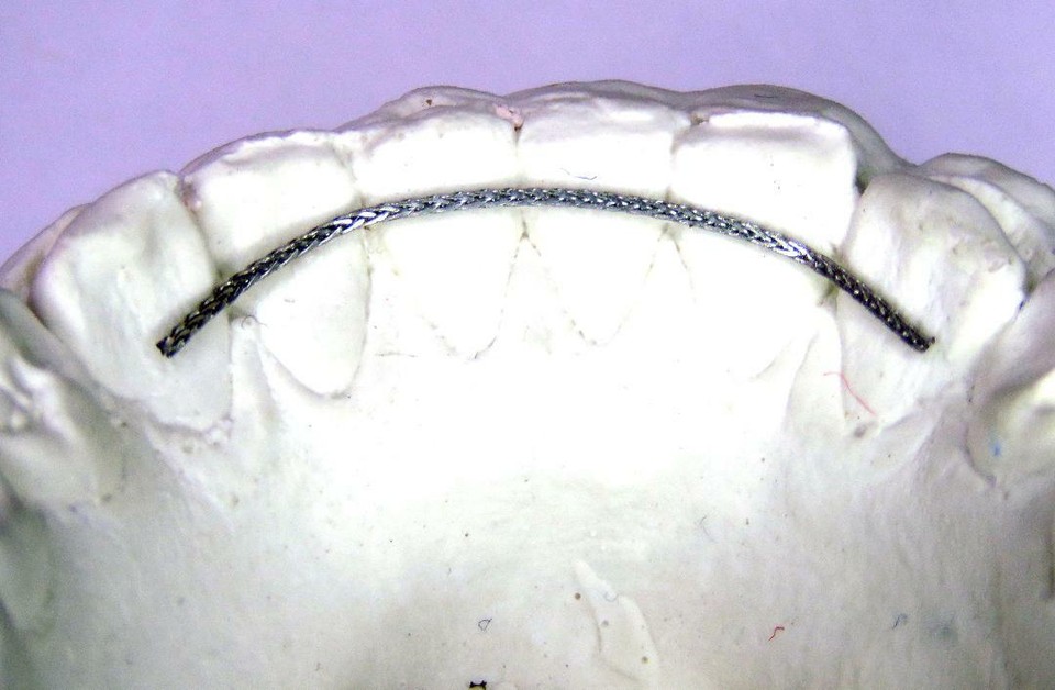 Dead Soft Flat Ortho Lingual Retainer Wire - 60" - Spool/ Roll/ Strips ...