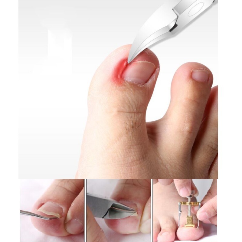 Professional Beauty Chiropody Podiatry Ingrowing Thick Toenail Surgery ...