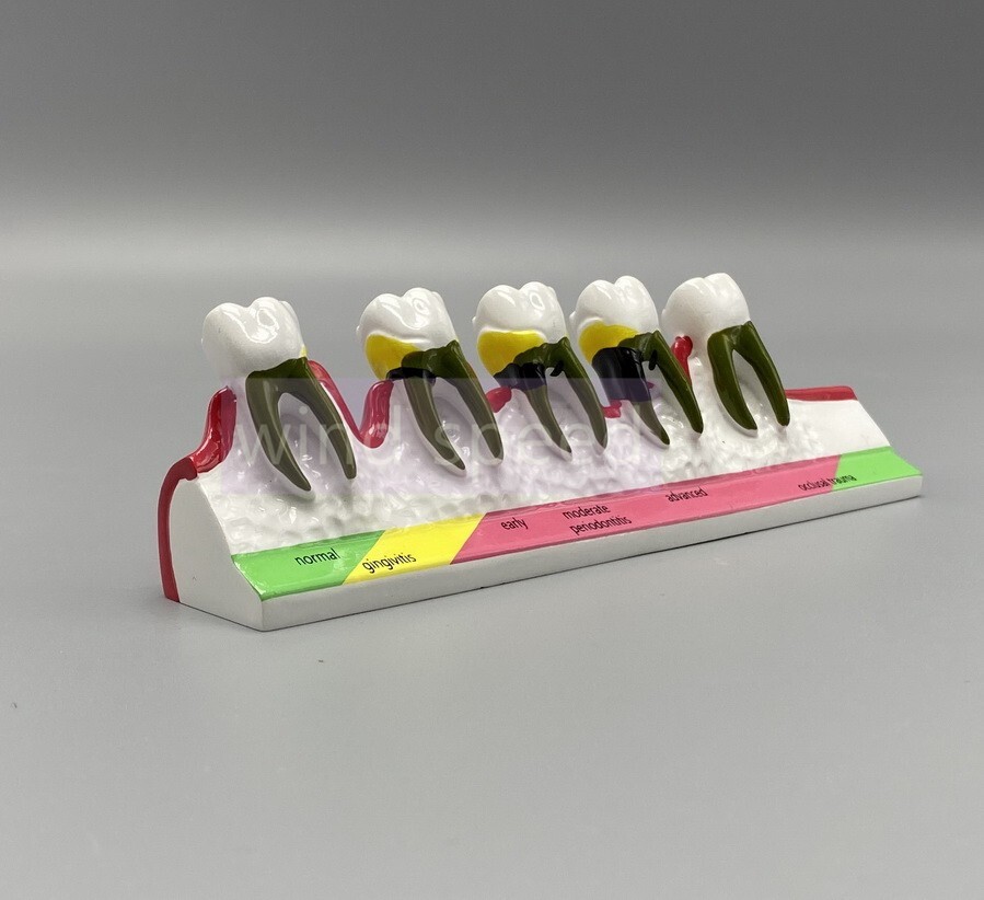 Dental Study Teaching Model Periodontal Disease Assort Teeth Dentoform ...