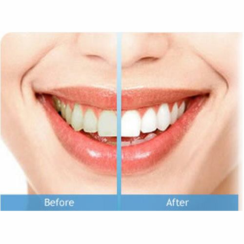 Dental DSI Prophy Air Prophylaxis Powder Teeth Polish Stain Remove ...