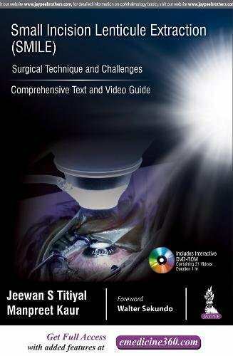 Small Incision Lenticule Extraction (SMILE): Su, Titiyal, Kaur ...