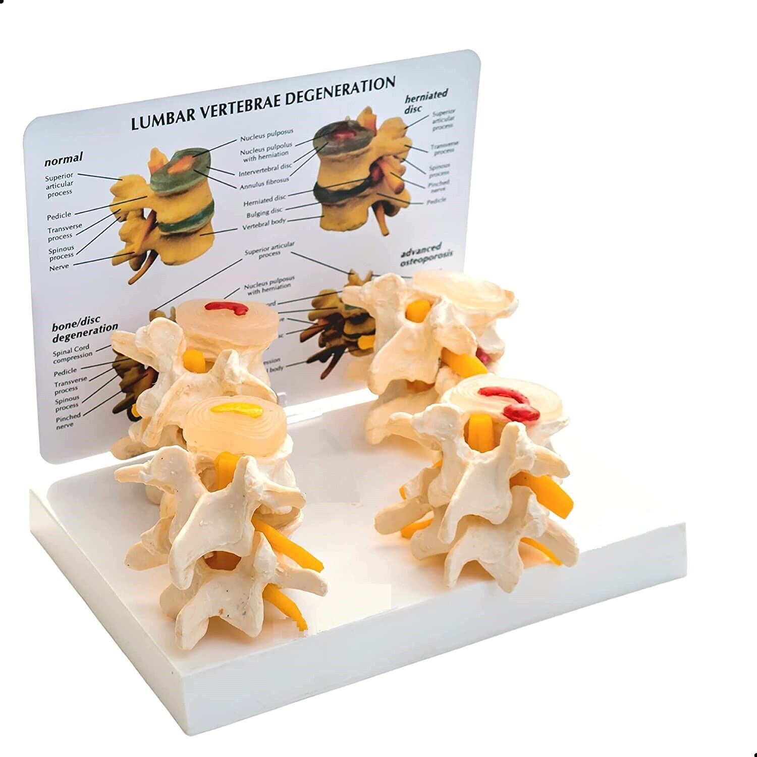 VERTEBRAE DEGENERATION MODEL | 4 STAGE DISC DEGENERATION SPINE MODEL ...