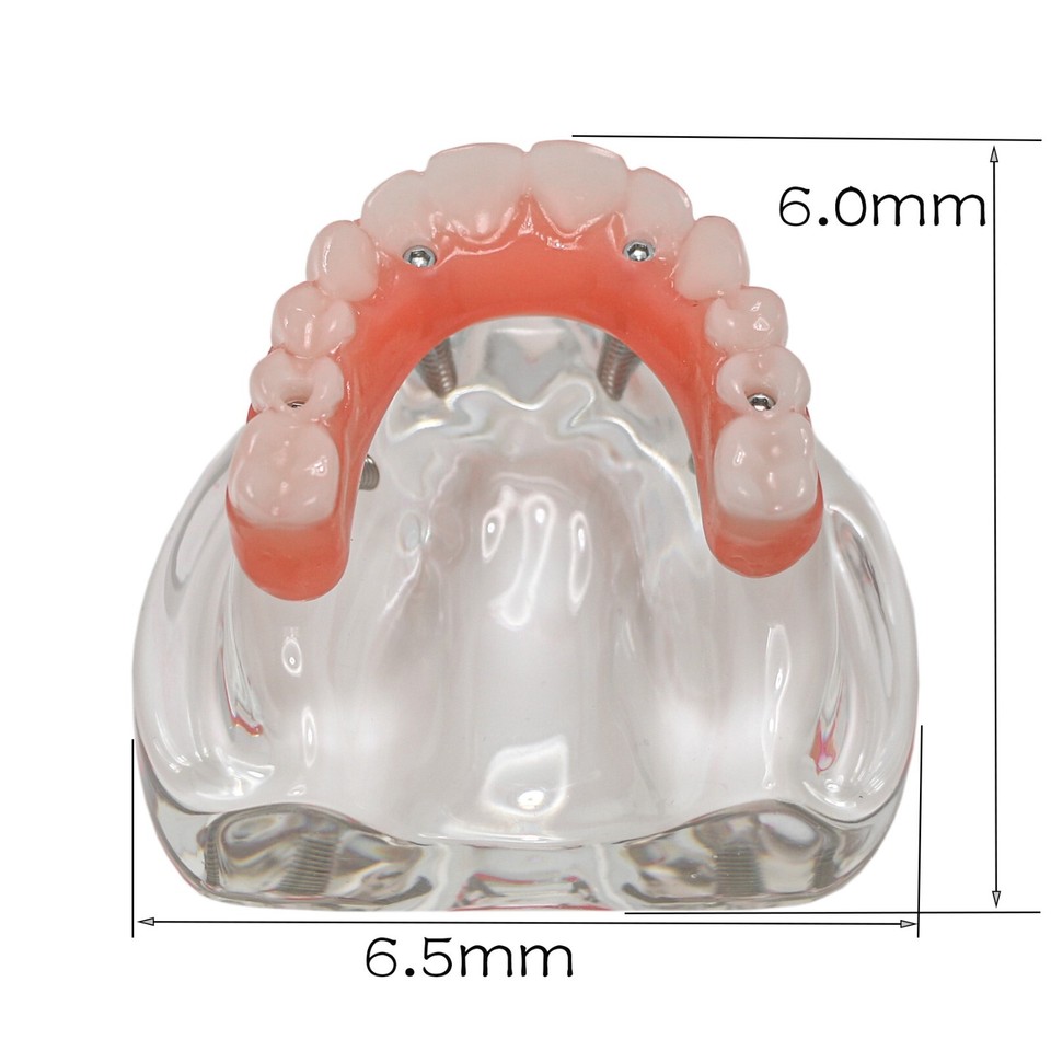 US Dental Implant Treatment Model All-on-4 Overdenture Upper Jaw 4 ...