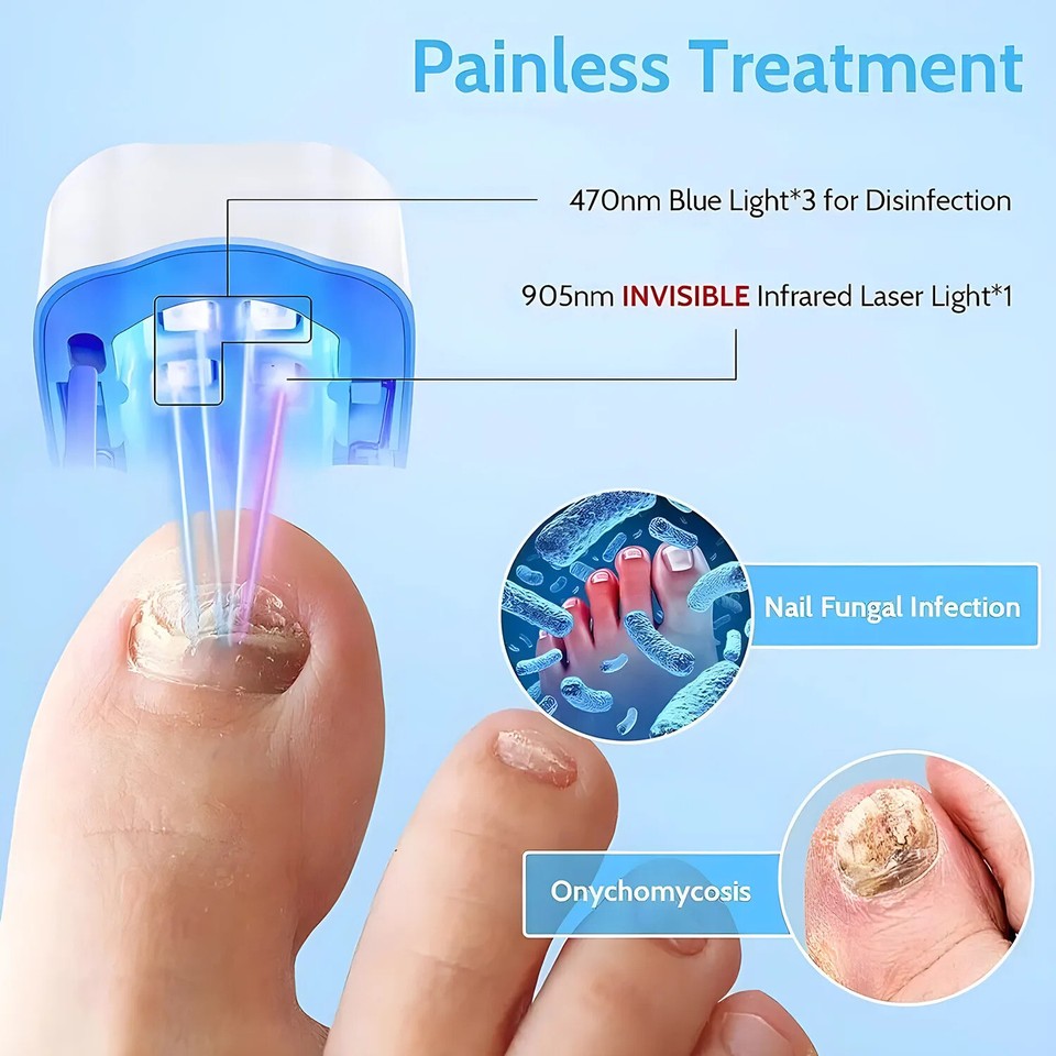 Portable Nail Fungus Treatment Device - Effective Fungal Nail Care Tool ...