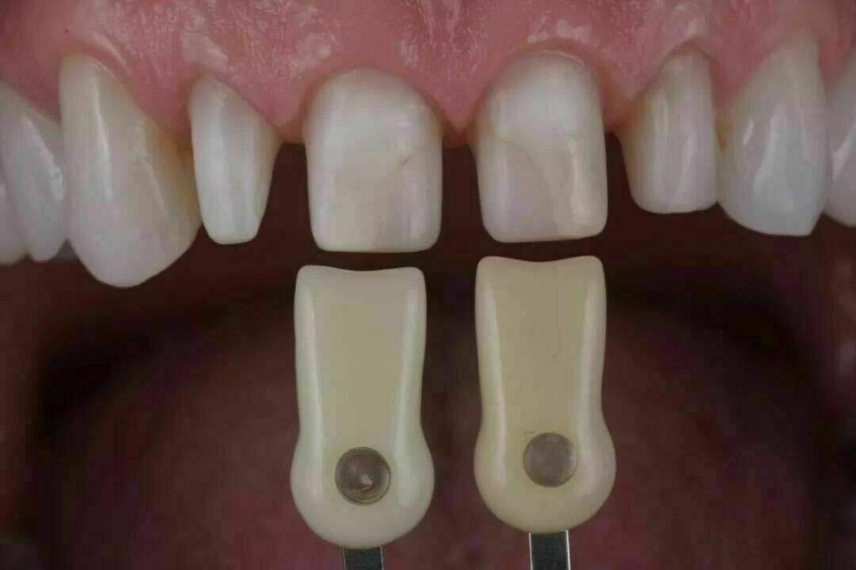 Dental IPS Natural Die Material Shade Guide Ivoclar Vivadent ND1-9 ...
