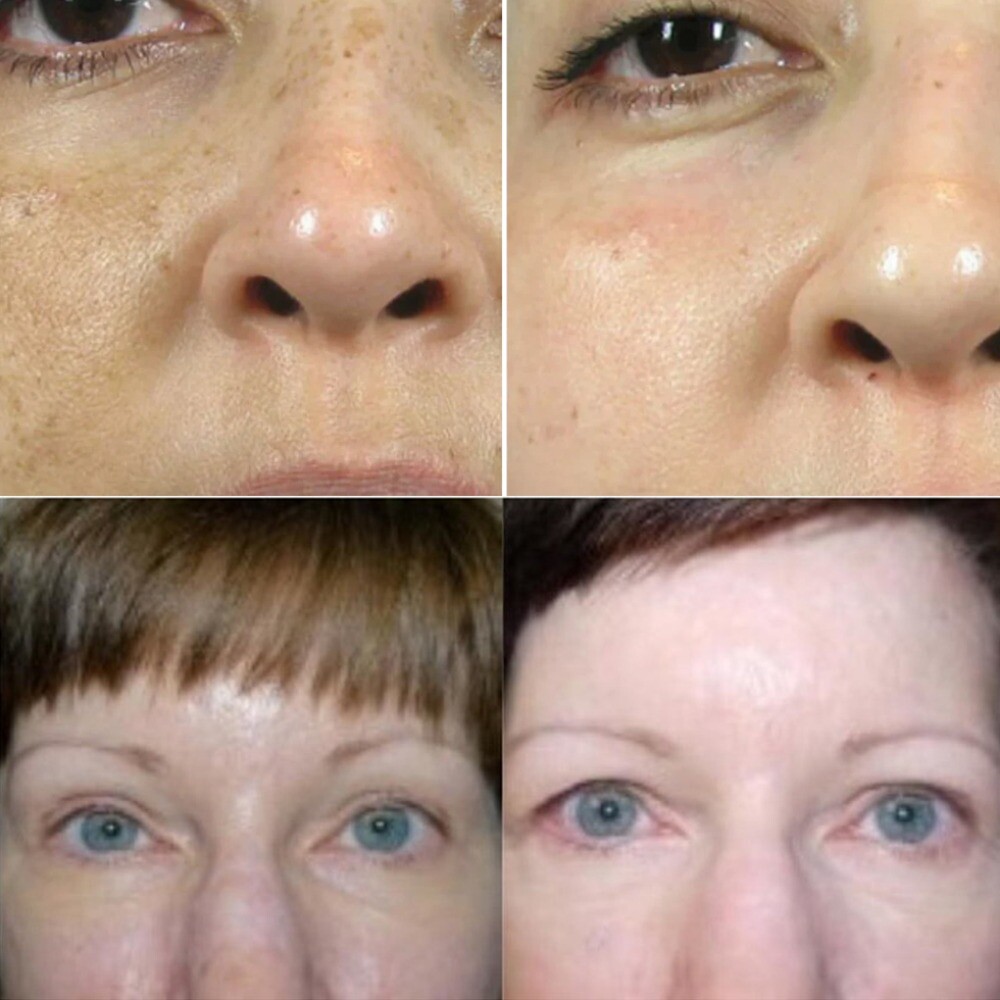 2025 Newest Professional Beauty Device Scar Pigment Removal Skin Care ...