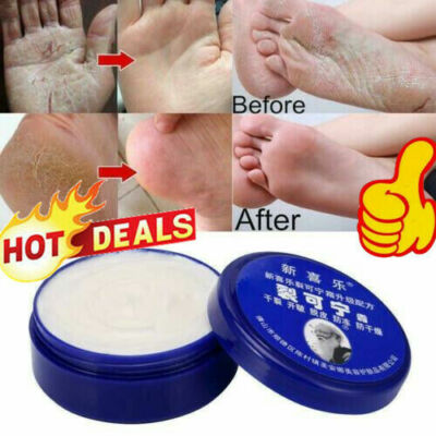 80ml Chilblain Frostbite Inflammation Warming Cream Effective Relief ...