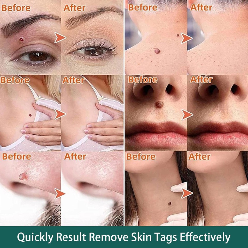 Skin Mole Remover 20ml Professional Painless Face Body Blemish Eraser ...
