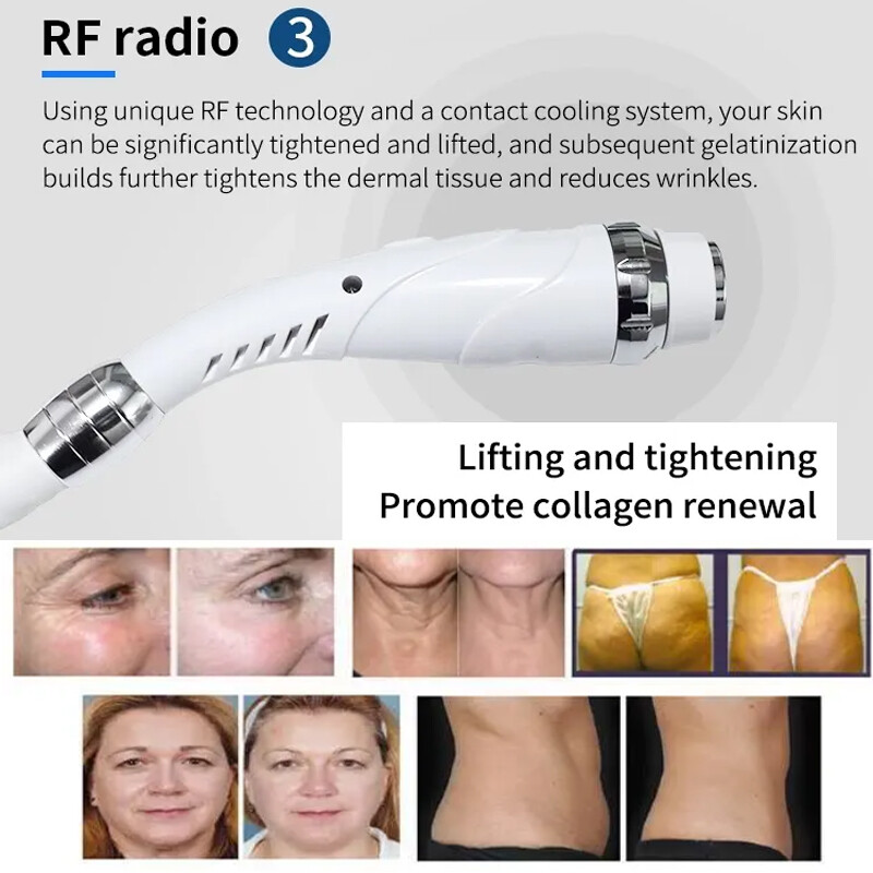 3in1 Elight ND YAG OPT Laser Hair Removal Tattoo Removal RF Skin ...