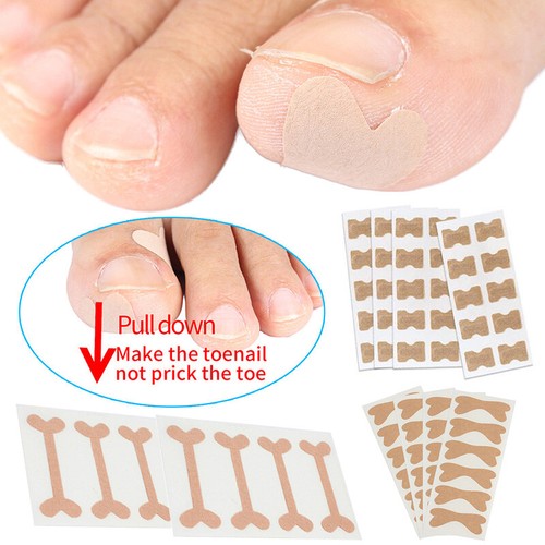 Nail Correcting Stickers Ingrowing Toenail Plasters Groove Treatment 4 ...