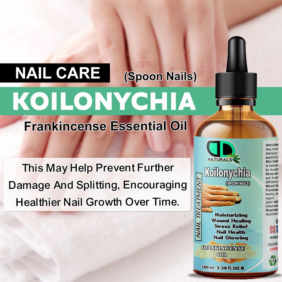 Koilonychia (Spoon Nails) Care Treatment | Enhance Nail Health ...