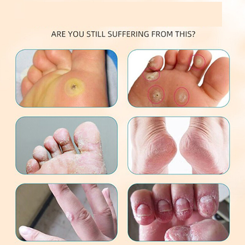 6PCS Foot Corn Remover Plaster Feet Callus Removal Detox Patch Health ...