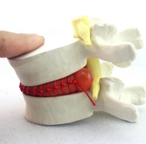 Lumbar Vertebra Slipped Disc Human Anatomical Medical Demonstration ...