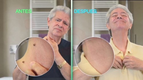 QUITA VERRUGA Original Sani Skin Away SaniSkin Tag Verrugas Remove Wart ...