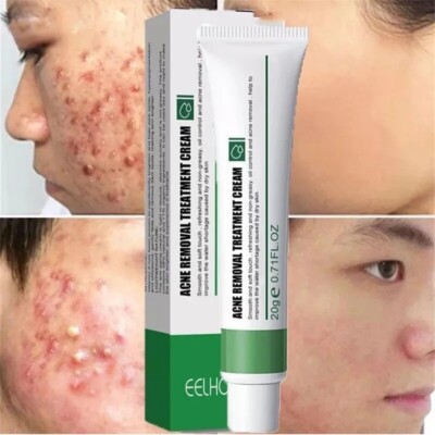 2pc Effective Acne Removal Cream Acne Treatment Skin Whitening Pimple ...