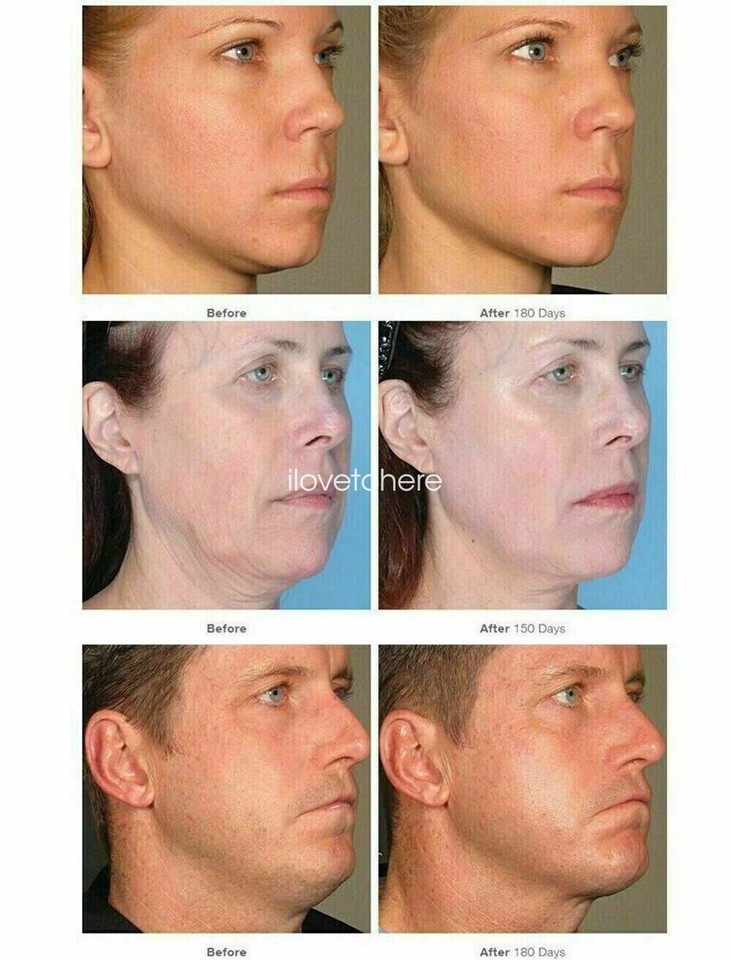 4D/3D/ Cartridge Tips Replacement Transducer Shots Probe Part For Face ...