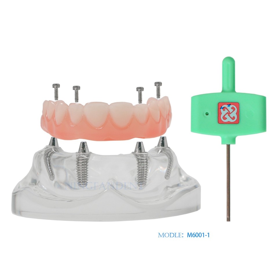 Dental Implant Modle,Lower Upper Jaw,RPD Dentures,Overdenture ...