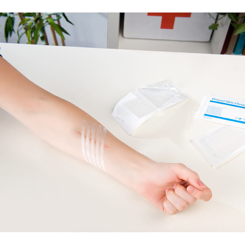 30er-Pack medizinische Wundnahtstreifen, Klammerpflaster, 100 x 6 mm ...