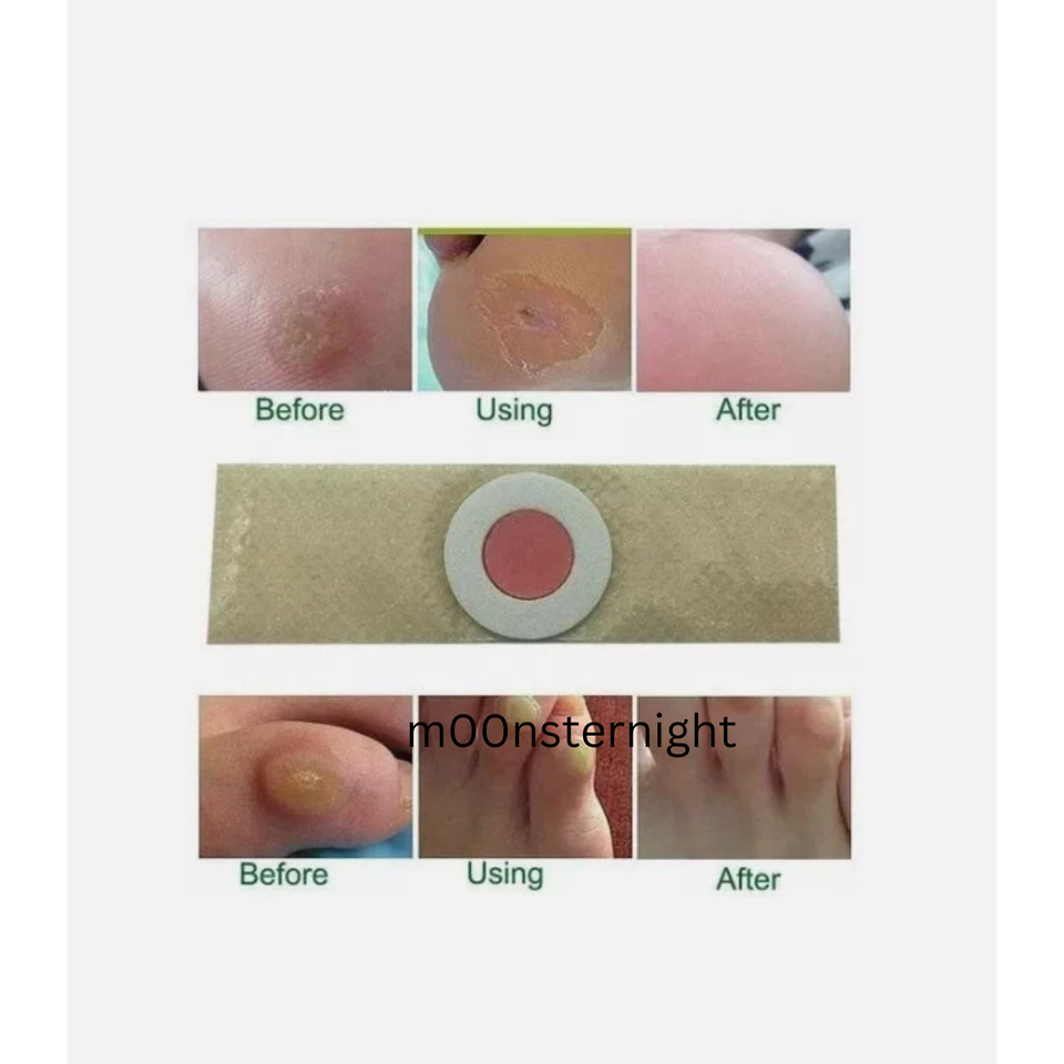 2x Carnation Footcare Corn Caps 5s Medicated Plasters for Corn & Callus ...