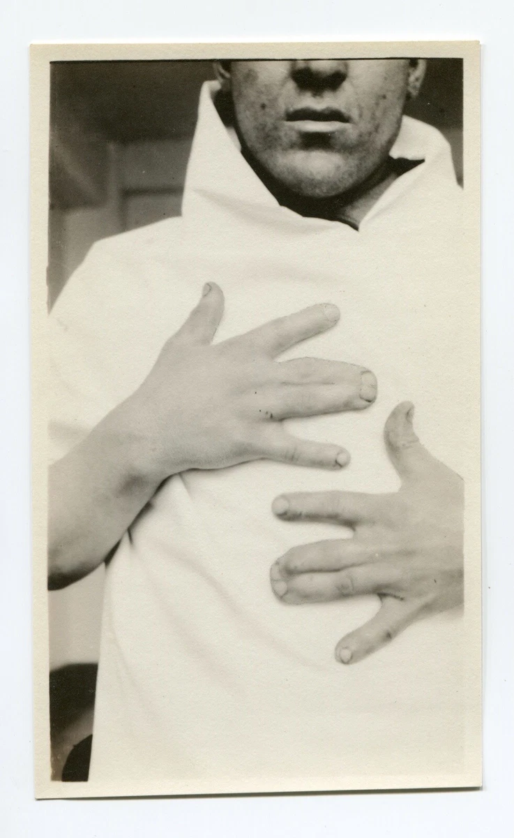 Webbed Fingers