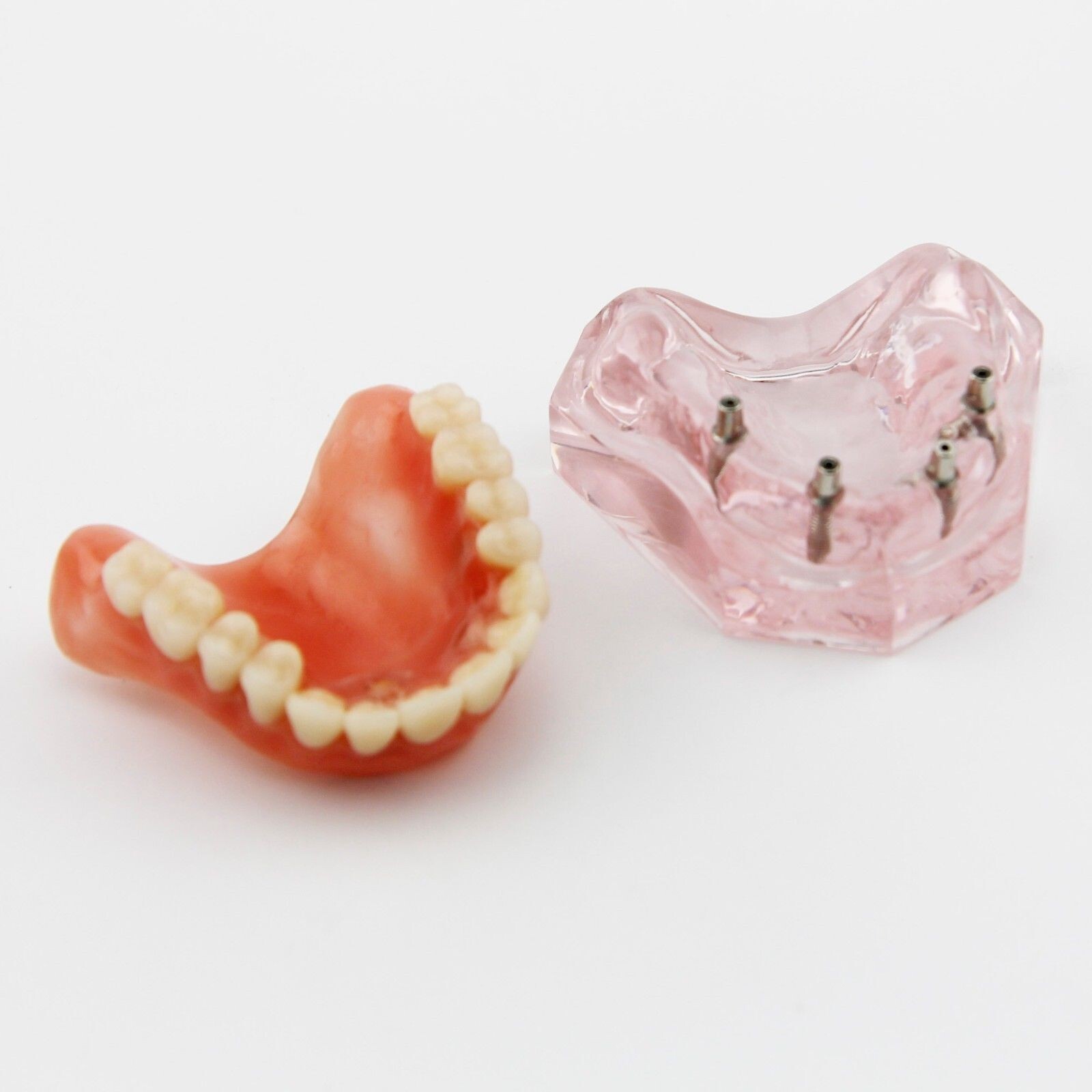 Dental Implant Demo Model Overdenture 4 Implants Maxillary Upper ...