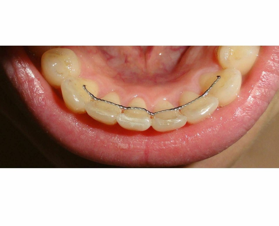 Dental Orthodontic Twisted Lingual Retainer Wire 3 Strands Braided 0175 ...