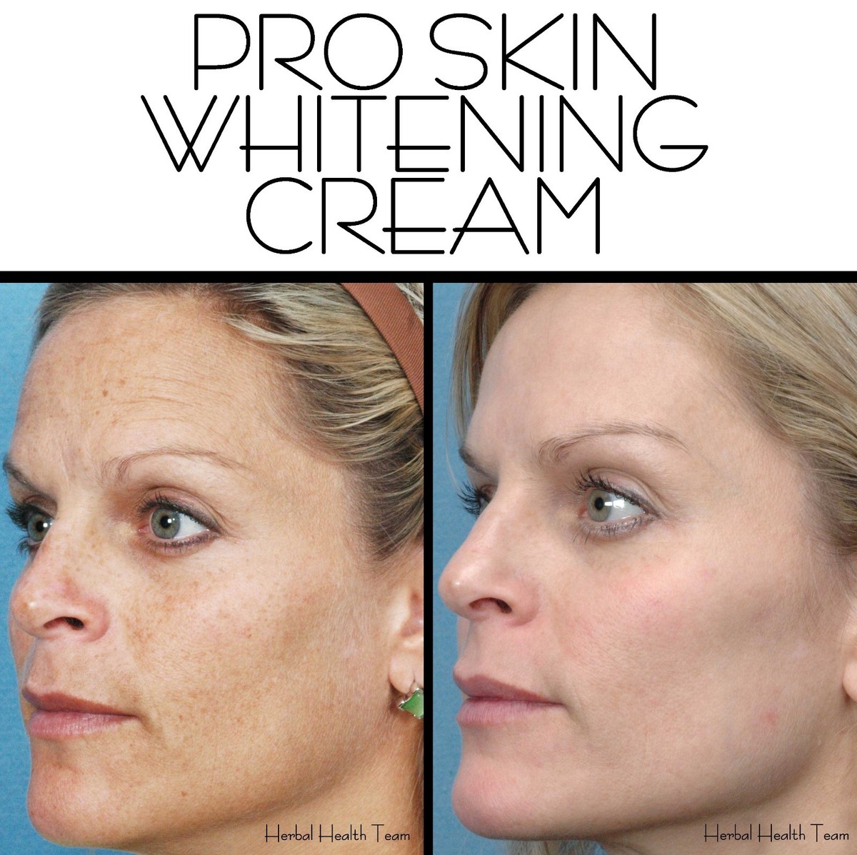 Skin Bleaching Results