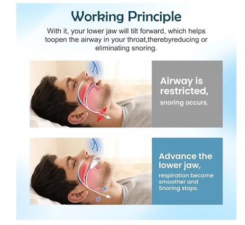 Anti-Snoring Device Mouth Piece - Stop Snore Aid Sleep Apnea Guard ...