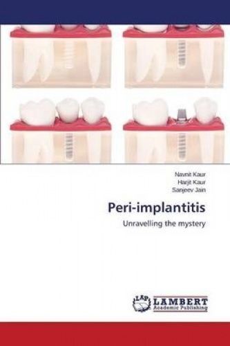 Peri-implantitis by Navnit Kaur, Sanjeev Jain, Harjit Kaur (Paperback ...