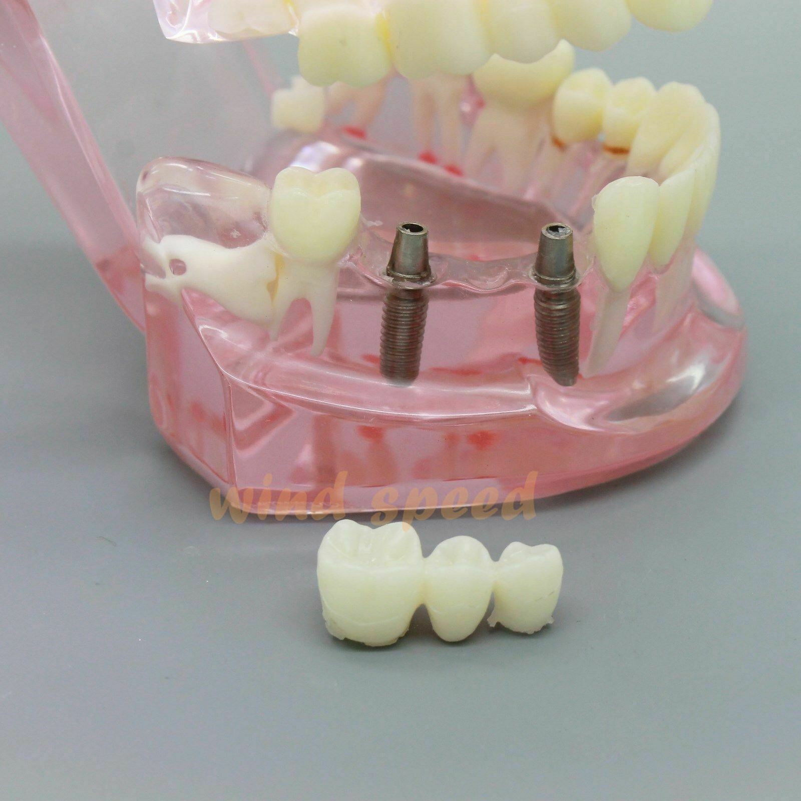Dental Implant Teeth Model Study Analysis Demonstration Disease ...
