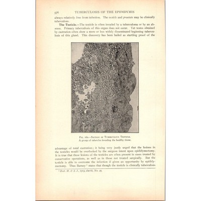 Tuberculosis Of Epididymis Vesicle & Prostate 1928 Urology Book Plate ...