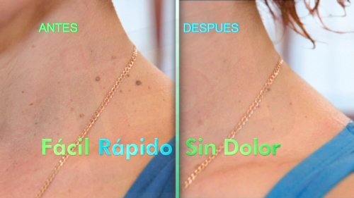 QUITA VERRUGA Original Sani Skin Away SaniSkin Tag Verrugas Remove Wart ...