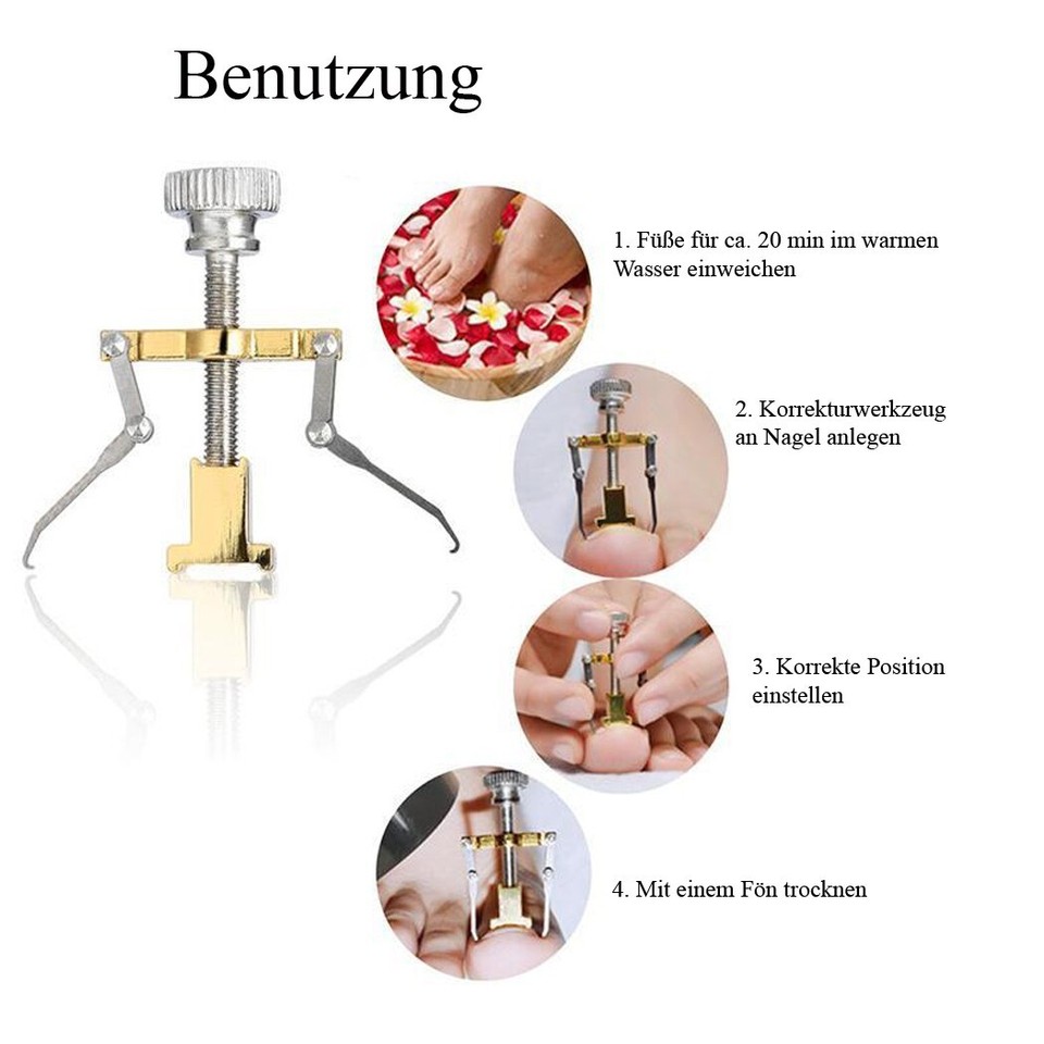 Eingewachsener Zehennagel Nagel Korrektur Fixer Fixieren Pediküre ...