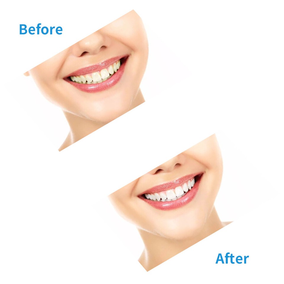 10/5x Dental Gingival Gel Dam Barrier Gum Protector Teeth Whitening Gel ...