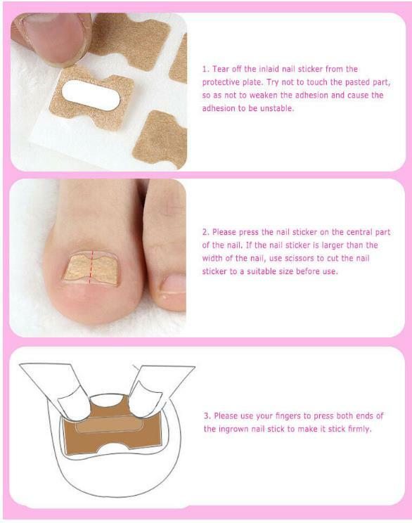 10 - 50pcs Ingrown Toe Foot Nail Correction Sticker Pedicure Toenail ...