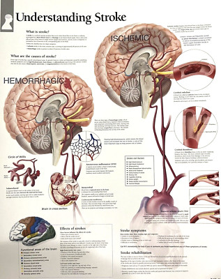 Understanding Stroke ~ Anatomy Poster ~ 11.25 x 14 inches | eBay