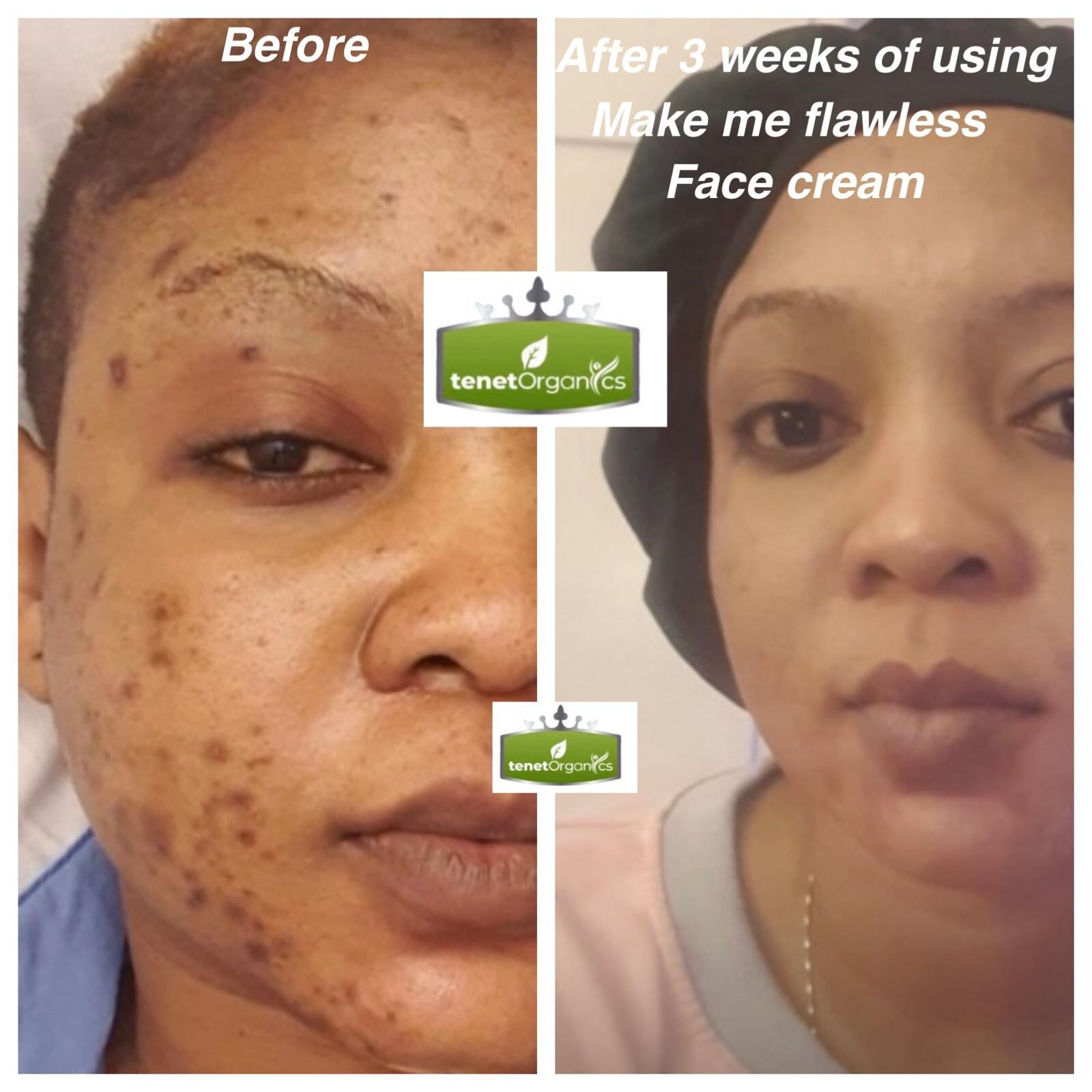 skin lightening face creams( Dark Mark, Hyperpigmentation, Acne Face ...