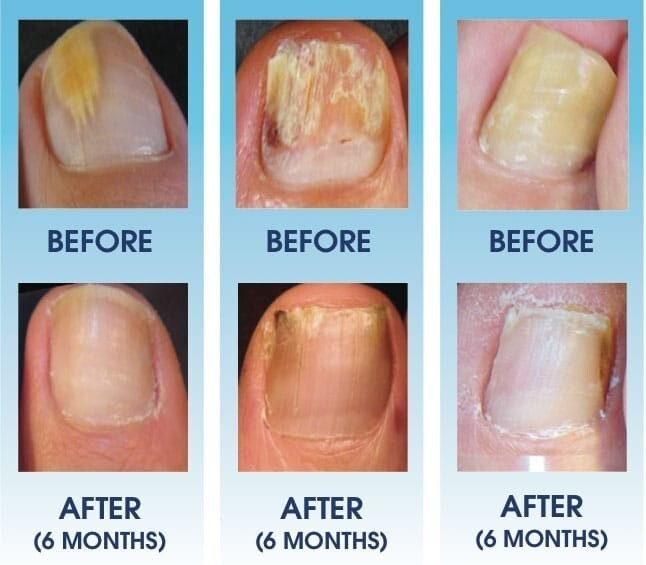 2 x Nail Fungus Treatment For Toe Finger Nail Fungal Infections #1 ...