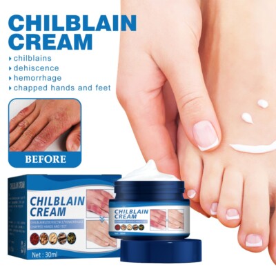 30 ml Chilblain Cream Anti-cracking Frostbite Moisturiser Deep ...
