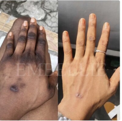 Dark Knuckle Remover Cream and Scrub Set DEAL, Dark Feet, Dark Marks ...