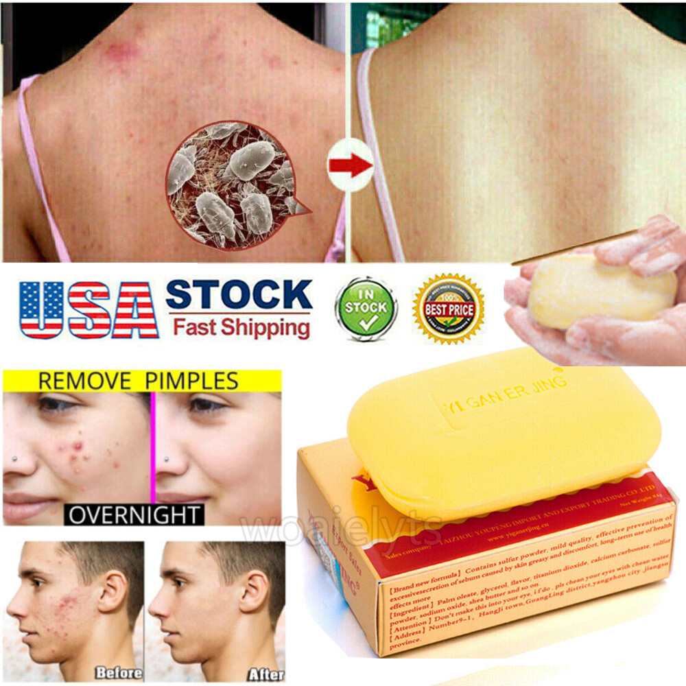 Sulfur Soap Anti Fungal Mites Scabies Acne Treatment Itching Body Bath ...