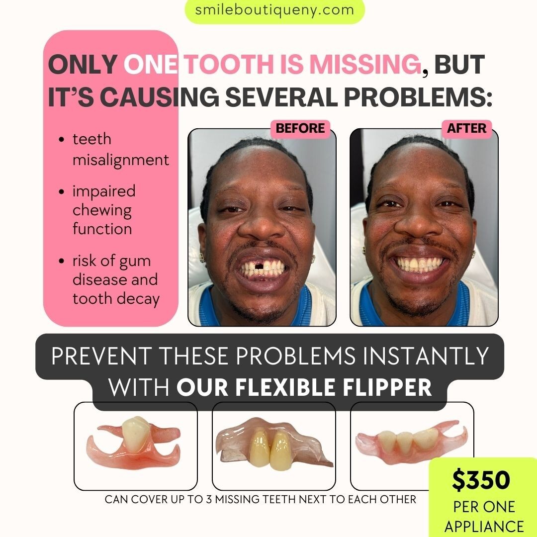 Nesbit, Flexi Flipper, Molar Flipper, Missing Canine Tooth, Flipper ...
